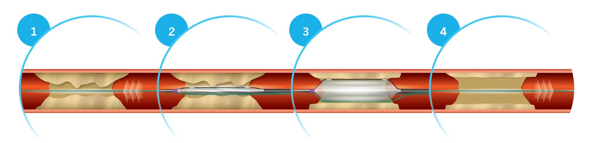 Scoreflex NC - OrbusNeich