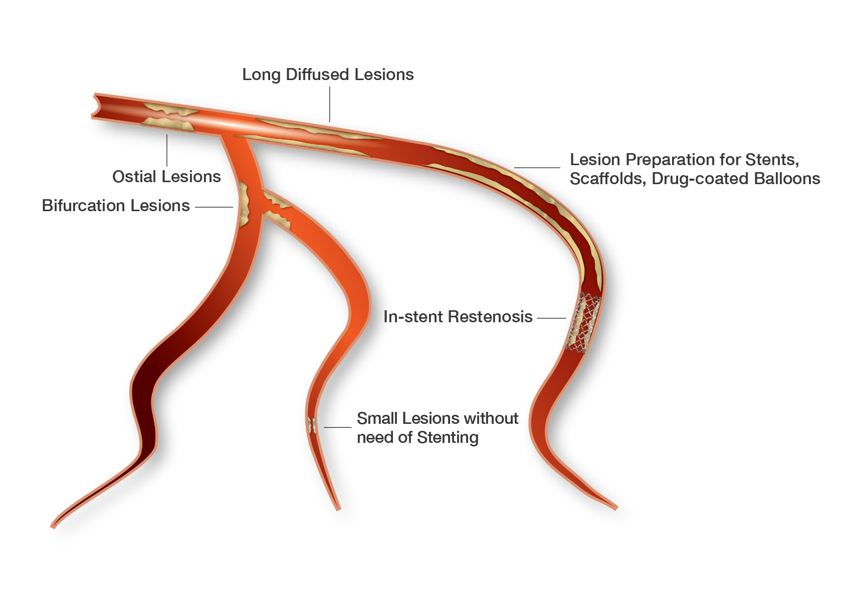 Scoreflex NC - OrbusNeich